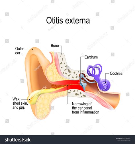 Swimmers Ear Otitis Externa Inflammation Ear Stock Illustration
