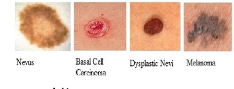 Benign Nevus Vs Melanoma
