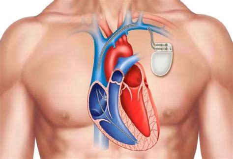 Pacemaker Implantation Surgery Cost In India Alsadal Services Private
