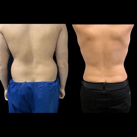 Male Liposuction Love Handles Procedure And Quick Recovery