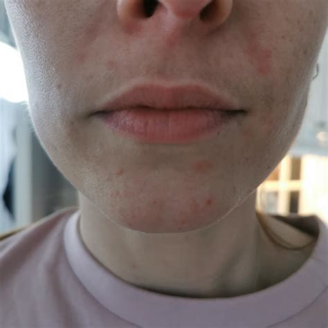 Is This Perioral Dermatitis Or Papulopustular Rosacea I Suffer