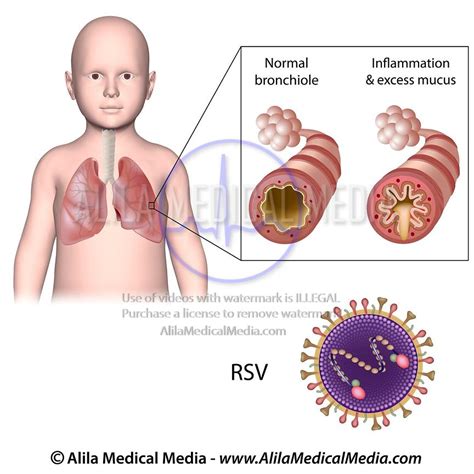 Alila Medical Media Bronchiolitis Caused By Rsv Medical Illustration