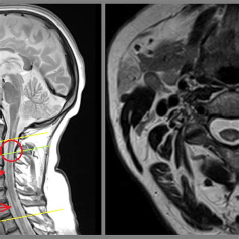 Mri Scan Of Cervical Spine Of A Patient With Multiple Sclerosis Showing Download Scientific