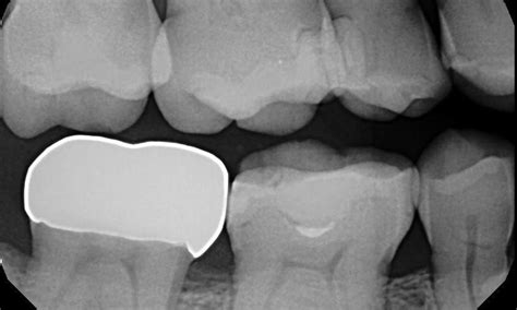 Porcelain Crowns Xray