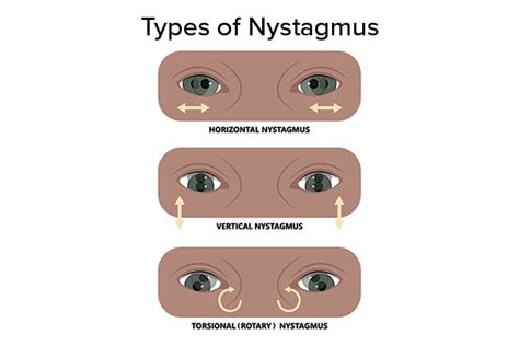 Nystagmus Types All About Vision