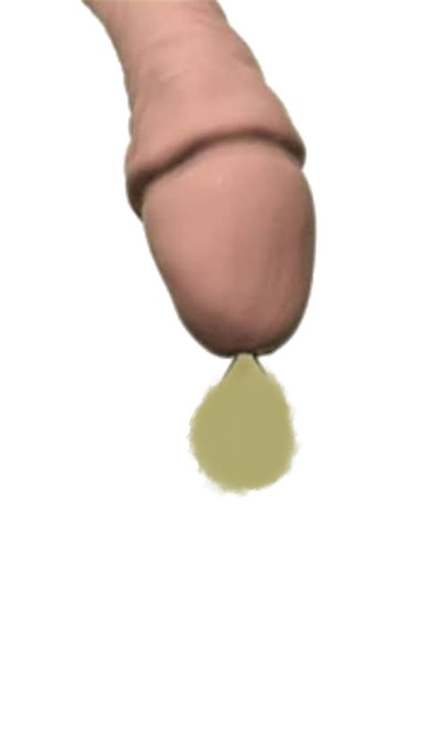 Gonorrhea Is A Sexually Transmitted Infection Sti Caused By The