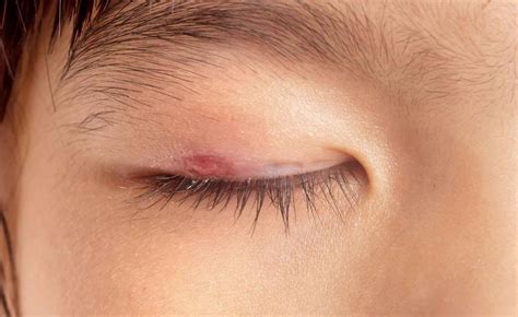 Stye Treatment