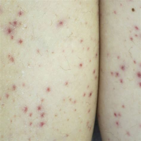 Vitamin Deficiency Rash