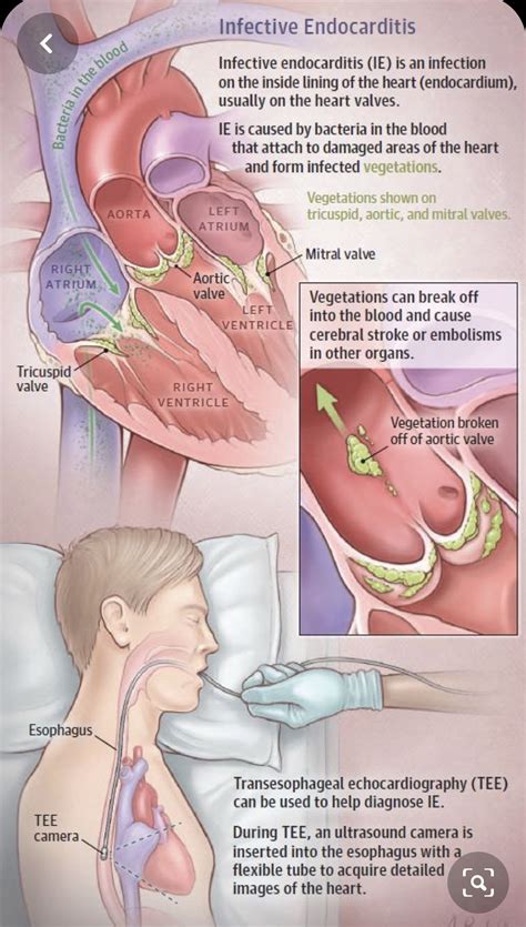 Valvular Pathologies Artofit