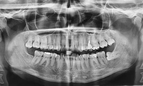 Impacted Wisdom Teeth In London Emergency Dentist Putney