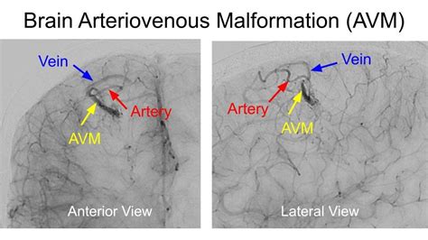 Arteriovenous Malformation — Matthew Mian Md