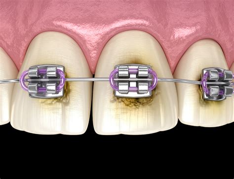 Will Braces Stain My Teeth Understand Prevent And Treat Braces Stains