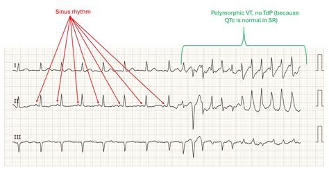 Polymorphic VT ECG Guru Instructor Resources