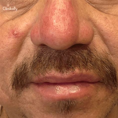 Swelling Under Nose Nose Piercing Bumps What Are They And How To