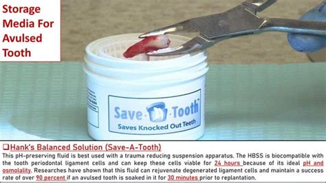 Tooth Avulsion Pdf