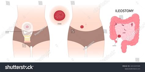 Colostomy Stoma Infection