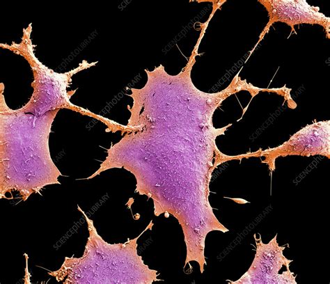 Breast Cancer Cells Sem Stock Image C0584739 Science Photo Library