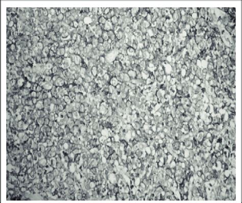 Photomicrograph Showing Membranous And Cytoplasmic Staining Of The