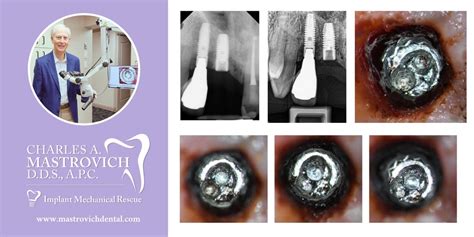 Another Example Of An Initial Imr Attempt Without Microscope Guidance