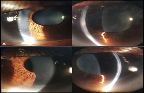 Posterior Amorphous Corneal Dystrophy New Chromosomal Break Cornea