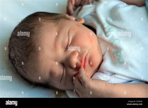 Erythema Toxicum Neonatorum