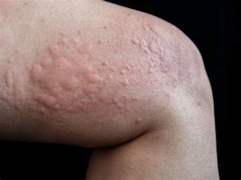 Bumpy Rash On Forearms