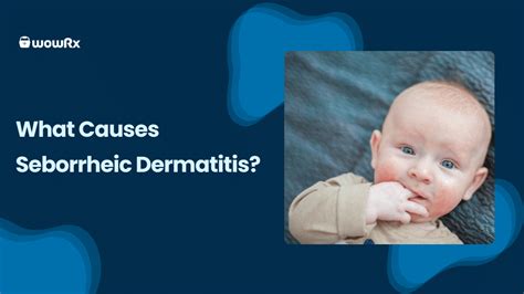 A Closer Look At What Causes Seborrheic Dermatitis