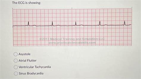 Solved The Ecg Is Showing Asystole Atrial Flutter