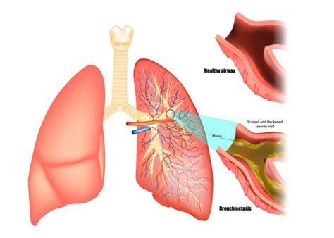 Bronchiectasis Dr Gopal Chawla