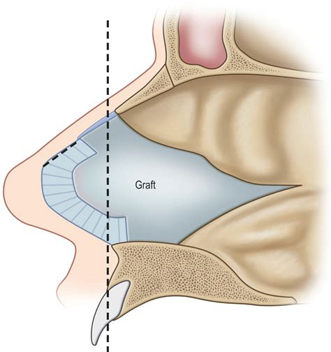 Repair Grafting And Engineering Of Cartilage Clinical Tree