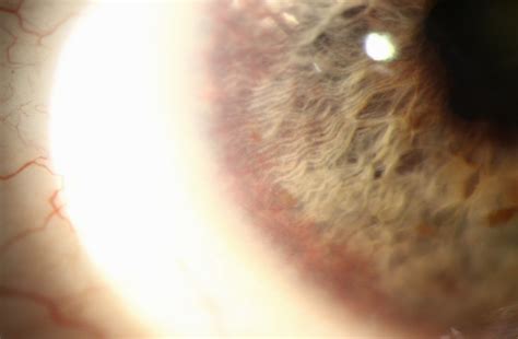 Atlas Entry Neovascularization Of The Iris Nvi Secondary To A
