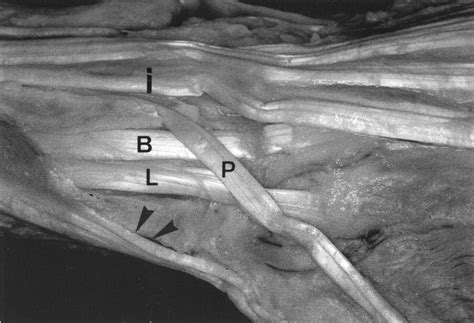 Extensor Pollicis Longus Cadaver