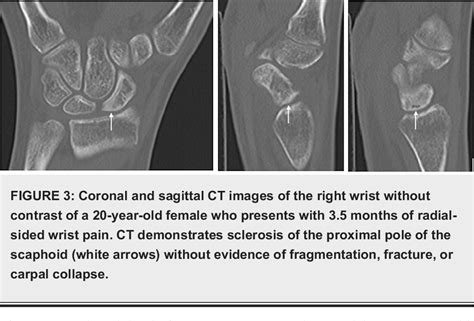 Figure 3 From A Nine Year Follow Up Of Stage Ii Preisers Disease