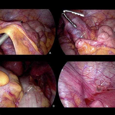 Exploratory Laparoscopy A And B Intraoperative View Of The Appendix