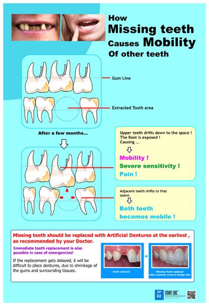 How Missing Teeth Causes Mobility Of Other Teeth Eng Dp 02 Smart Doc Posters