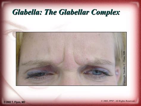 Facial Aging Process And Anatomy Ppt