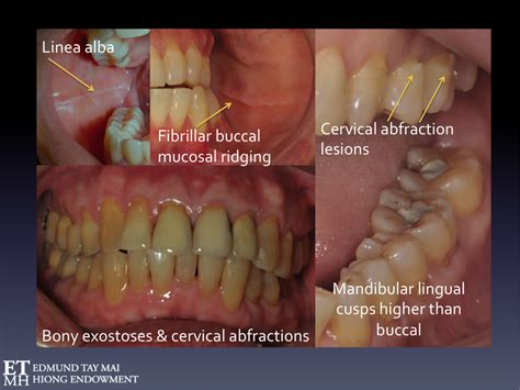 Awake Bruxism Ab And The Masseter Muscle Hypertrophy Controversy