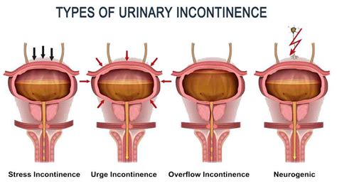Pelvic Floor Biofeedback For Urinary Incontinence Role Of Stim