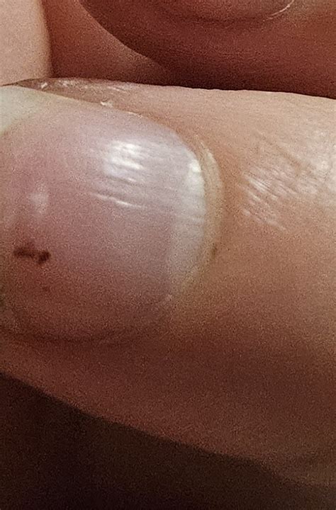 Splinter Hemorrhage R Askdocs