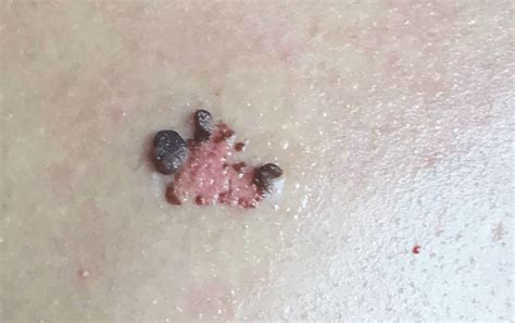 Another Verrucous Epidermal Nevus Characterized By Well Circumscribed