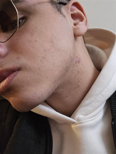 Either Ingrowns And Pimples Or A Shitty Excuse Of A Beard Rbeardadvice