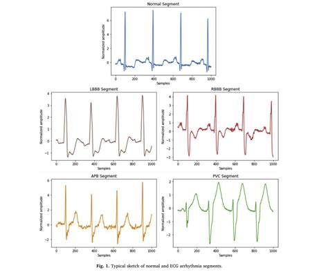 Automated Diagnosis Of Arrhythmia Using Combination Of Cnn And