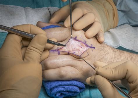 Extensor Tenolysis And Intrinsic Release Of The Hand Orthoracle Luanmd