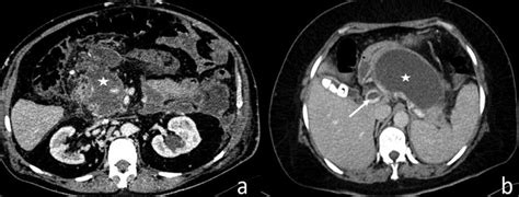 Walled Off Necrosis Asterisk Surrounding Portal Vein A And Walled
