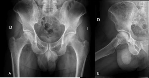 Rayos X O Radiografía De Cadera Unilateral Ap Vizua