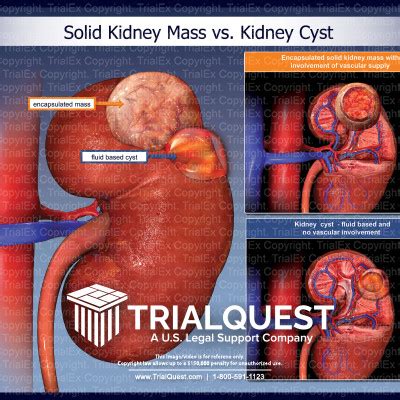Medical Legal Exhibits Legal Animations And Trial Graphics Tria