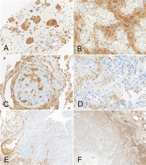 Mtap As An Emerging Biomarker In Thoracic Malignancies Lung Cancer