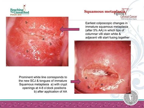 Colposcopy Ppt Medical Health