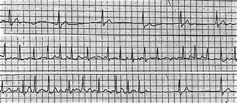 Sick Sinus Syndrome And Pacemaker Youbasta
