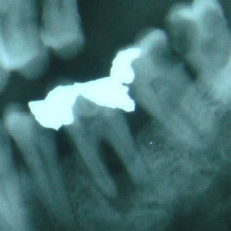 Intraoral Periapical Radiographs Confirming The Class Iii Furcation